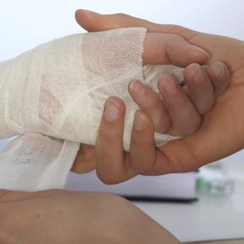How To Treat A Second Degree Burn - 6 steps